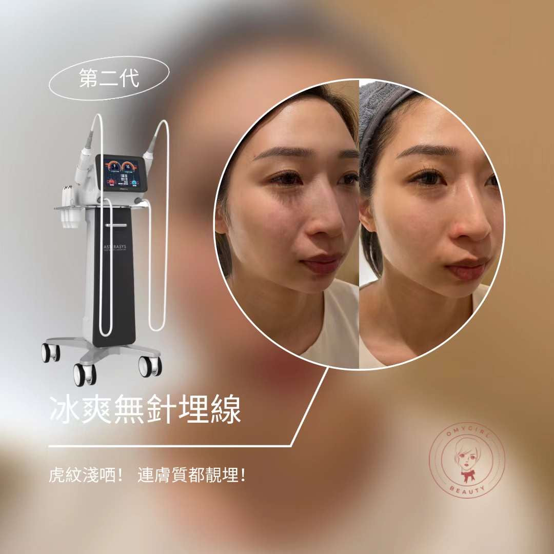 第五代Liftera Cool冰爽無針埋線 – OMyGirl Beauty